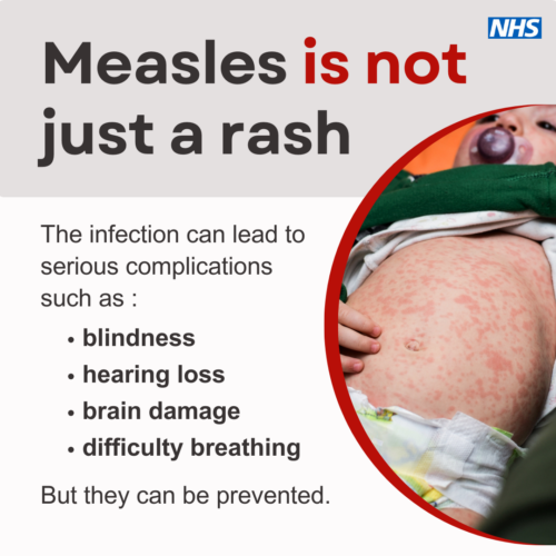 Measles – it’s more than just a rash - Carepoint Practice